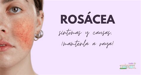 Rosácea Síntomas Y Causas El Blog Tañá1