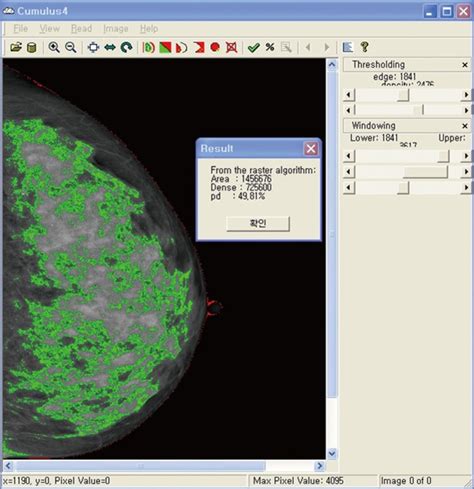 Computer Assisted Semi Automated Thresholding Method Cumulus™ The