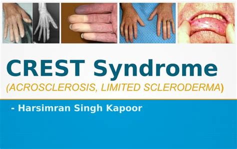 Crest Syndrome Pdf
