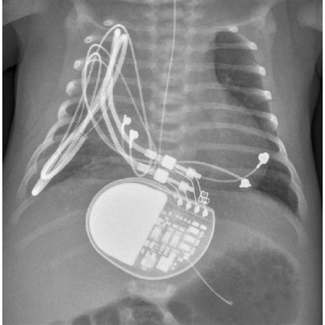 Pdf Pacemaker Implantation In Neonates And Infants Favorable