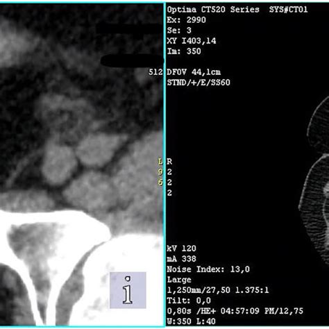 Pelvic Ct Scan Image In Axial Plane Showing Mass Like Thickening Of The