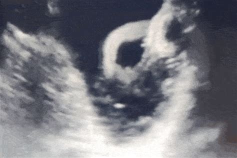 Parasitic Worms మనిషి పొట్టలో పాములు అటూ ఇటూ కదులుతూ News18 తెలుగు