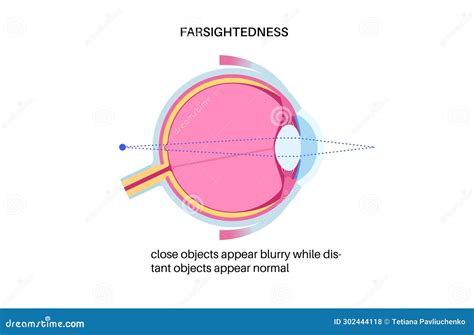 Farsightedness Eye Disease Stock Vector Illustration Of Long 302444118