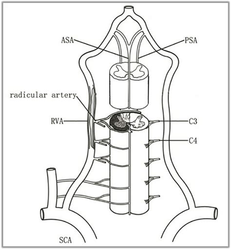 Vertebral Arterial Dissection Pacs