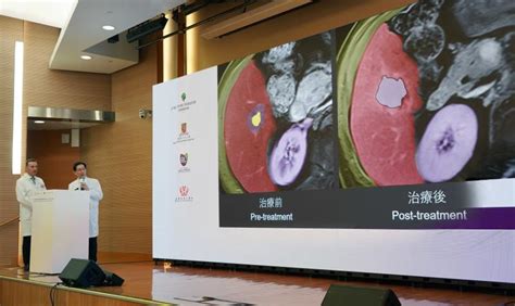 Histotripsy 20 Available For Liver And Breast Cancer Clinical Trials In Hk Multidisciplinary