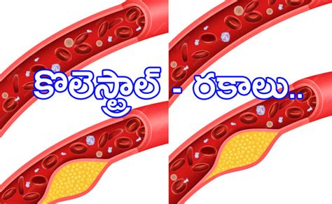 Cholesterol కొలెస్ట్రాల్ లో ఎన్ని రకాలు ఉన్నాయంటే Cholesterol