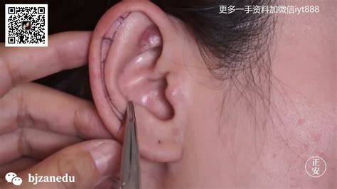 第71讲：取穴定位——风溪 Youtube