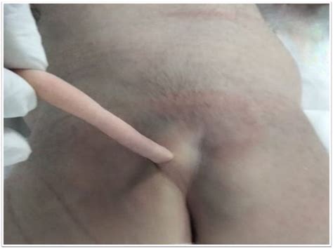 Caudal Appendage Human