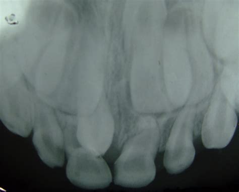 Hyperdontia X Ray