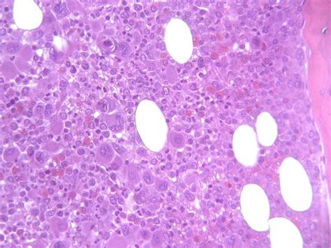 Small Hypolobated Megakaryocytes