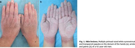 What Is Your Diagnosis See Next Page For Answer