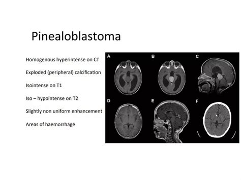 Surgical Pineal Region Tumorspptx