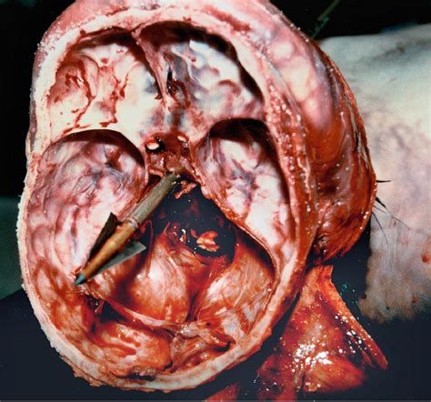 Autopsy Morbid Xxx Files Funny Cocks And Best Free Porn R34