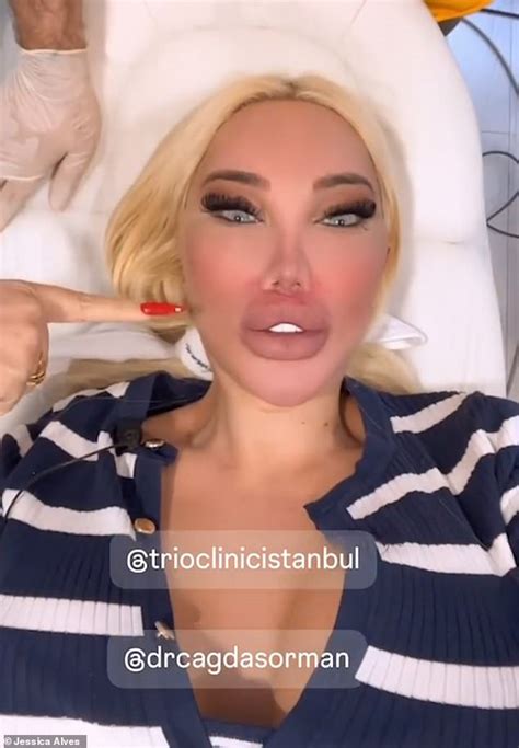 Jessica Alves Shows Off The Results Of Her Recent Anti Aging Procedure