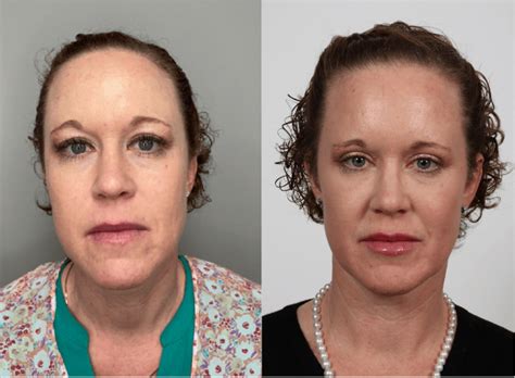 Bbl Broadband Light Gallery Peak Plastic Surgery