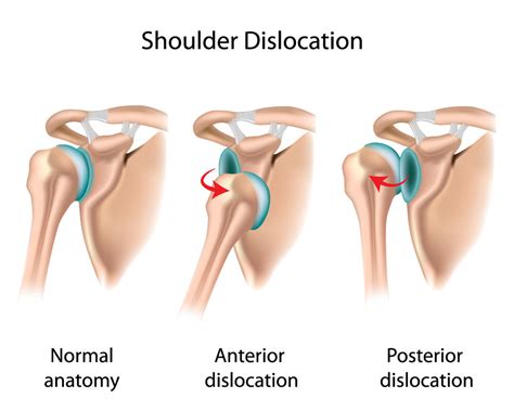 Shoulder Dislocation Shoulder Separation Austin Round Rock Cedar
