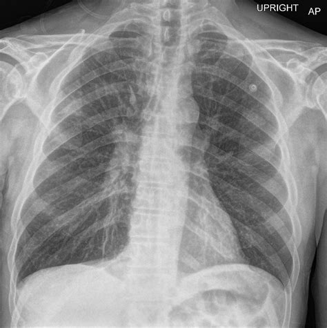 Chest X Ray Pneumonia Vs Bronchitis