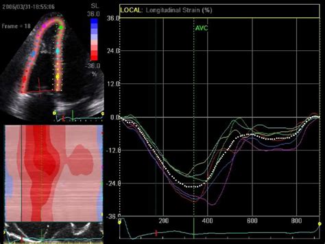 75574537 Assessment Of Right Ventricular Functionppt