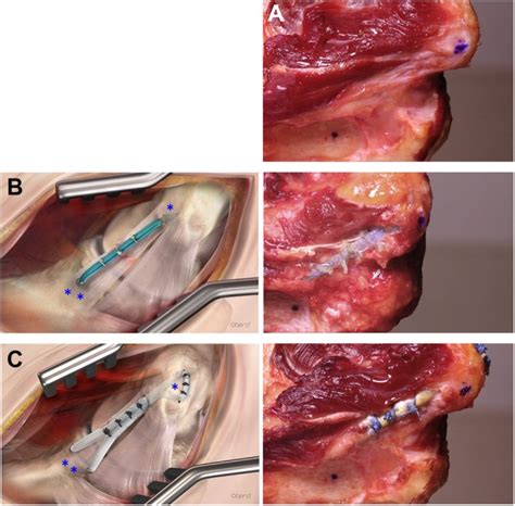 Ulnar Collateral Ligament Reconstruction Versus Repair With Internal