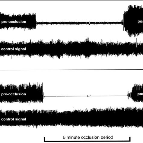 Representative Reactive Hyperaemia Peripheral Arterial Tonometry