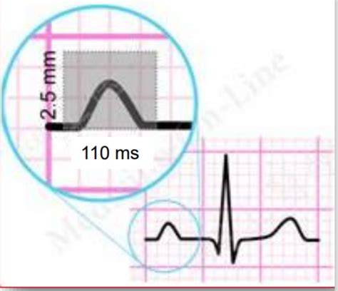 Topic 2 Ecg Atrial Enlargement Ventricular Hypertrophy Flashcards
