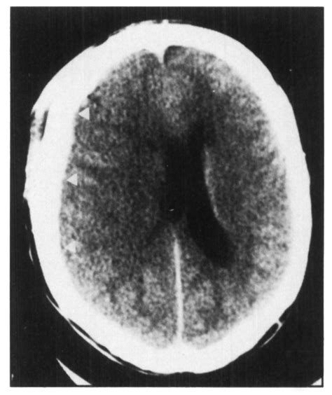 Acute Right Subdural Hematoma White Arrows With Midline Shift On