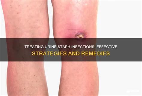 Treating Urine Staph Infections Effective Strategies And Remedies