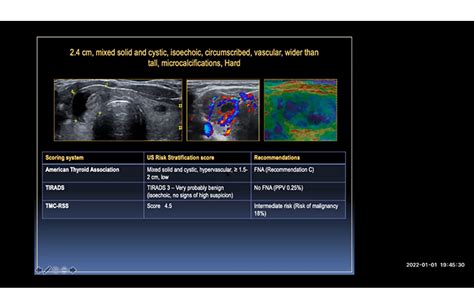 Thyroid Nodule Assessment Ultrasonography