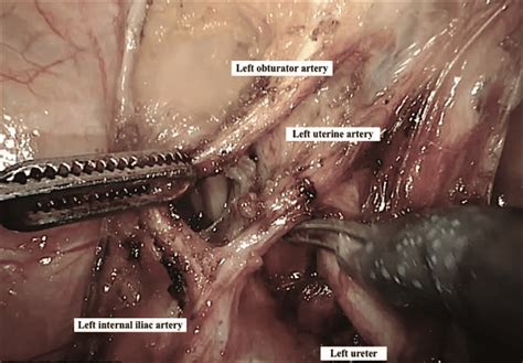 Robotic Posterior Exenteration Showing Dissection Of Left Uterine