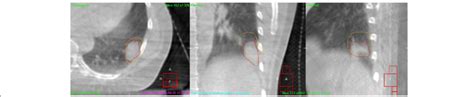 Precorrection Cone Beam Ct Cbct Image For An Protocol Nsclc Patient