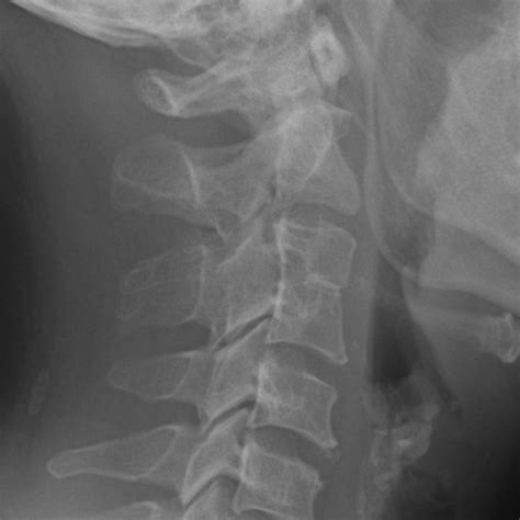 Klippel Feil Syndrome Radiology Klippel Feil Anomaly Spot Diagnosis