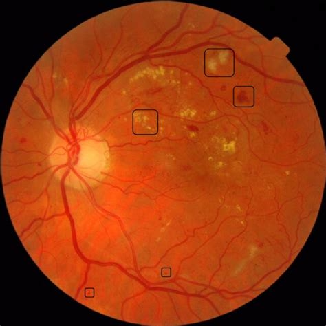 Characteristics Microaneurysms Hemorrhage Hard Exudate And Soft