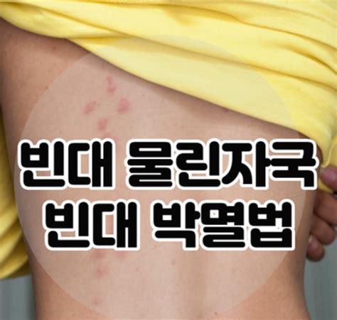 빈대 퇴치법
