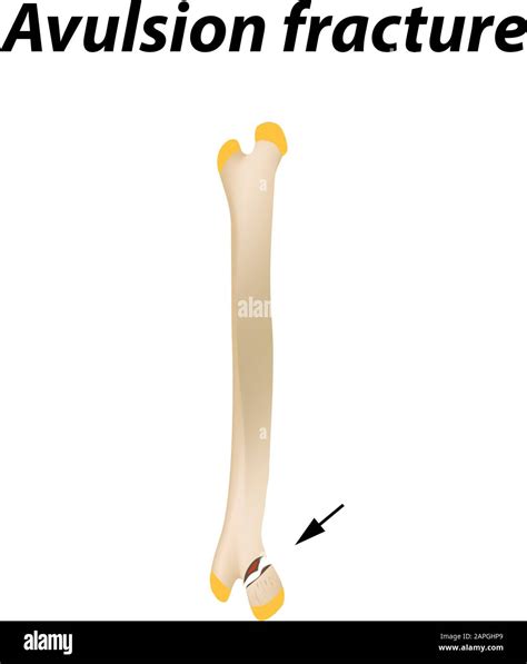 Femoral Avulsion Fracture