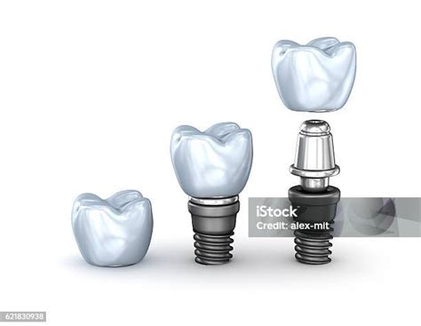 흰색 배경 3d 그림에 격리 된 치아 임플란트 치아 임플란트에 대한 스톡 사진 및 기타 이미지 치아 임플란트 임플란트 치아 건강 Istock