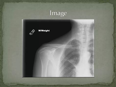 Ac Joint Separation Ppt