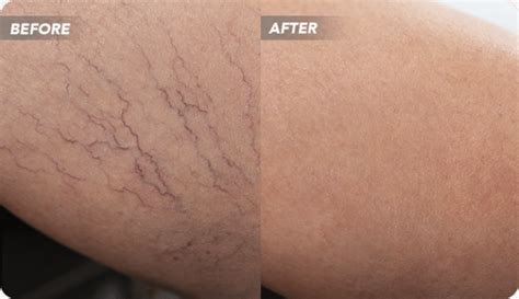 Varicose Veins Before And After Varicose Vein Treatments In Nyc