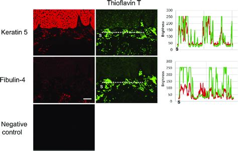 The Amyloid Deposits In Lichen Amyloidosis Skin Derived From Patient 4