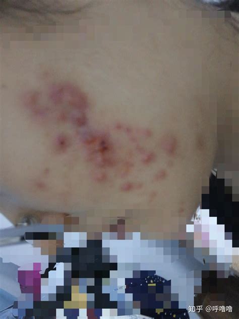 服用异维a酸记录贴 知乎