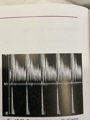 Doppler Pictures Flashcards Quizlet