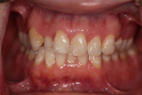 Aligner Therapy Tyngsboro Massachusetts Tyngsboro Cosmetic Dentistry
