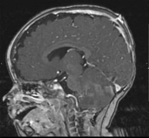 Sinus Pericranii Pacs