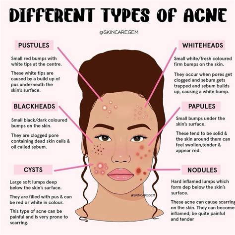 Different Types Of Acne In 2025 Different Types Of Acne Acne Types