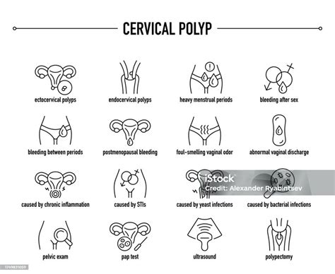 Cervical Polyp Symptoms Diagnostic And Treatment Vector Icons Stock