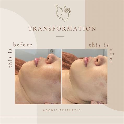 잠실피부관리•송파피부관리•석촌피부관리• 대표원장 정나라 Adonisaesthetic • Instagram Photos