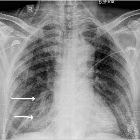Chest X Ray Follow Up Revealed Significant Infiltrates Over Right Lower