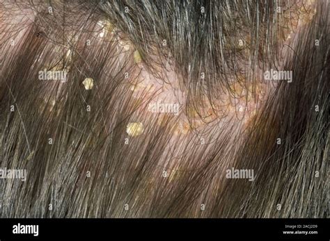 Hard Flaky Skin On Scalp How To Fix Flaky Scalp Kltg
