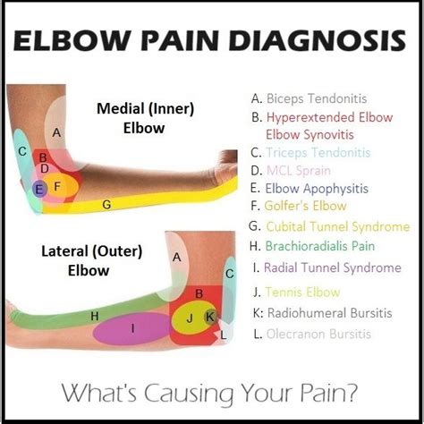 Forearm Tendonitis Symptoms Causes Treatment Artofit