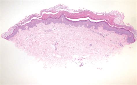 Filiform Papule Foot Planter