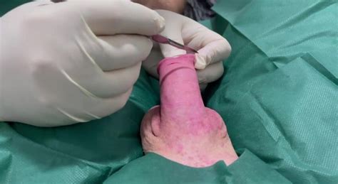 Circumcision Revision To Ultra Lowpart03